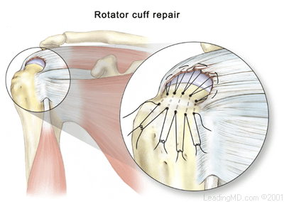 Rotator Cuff / Impingement